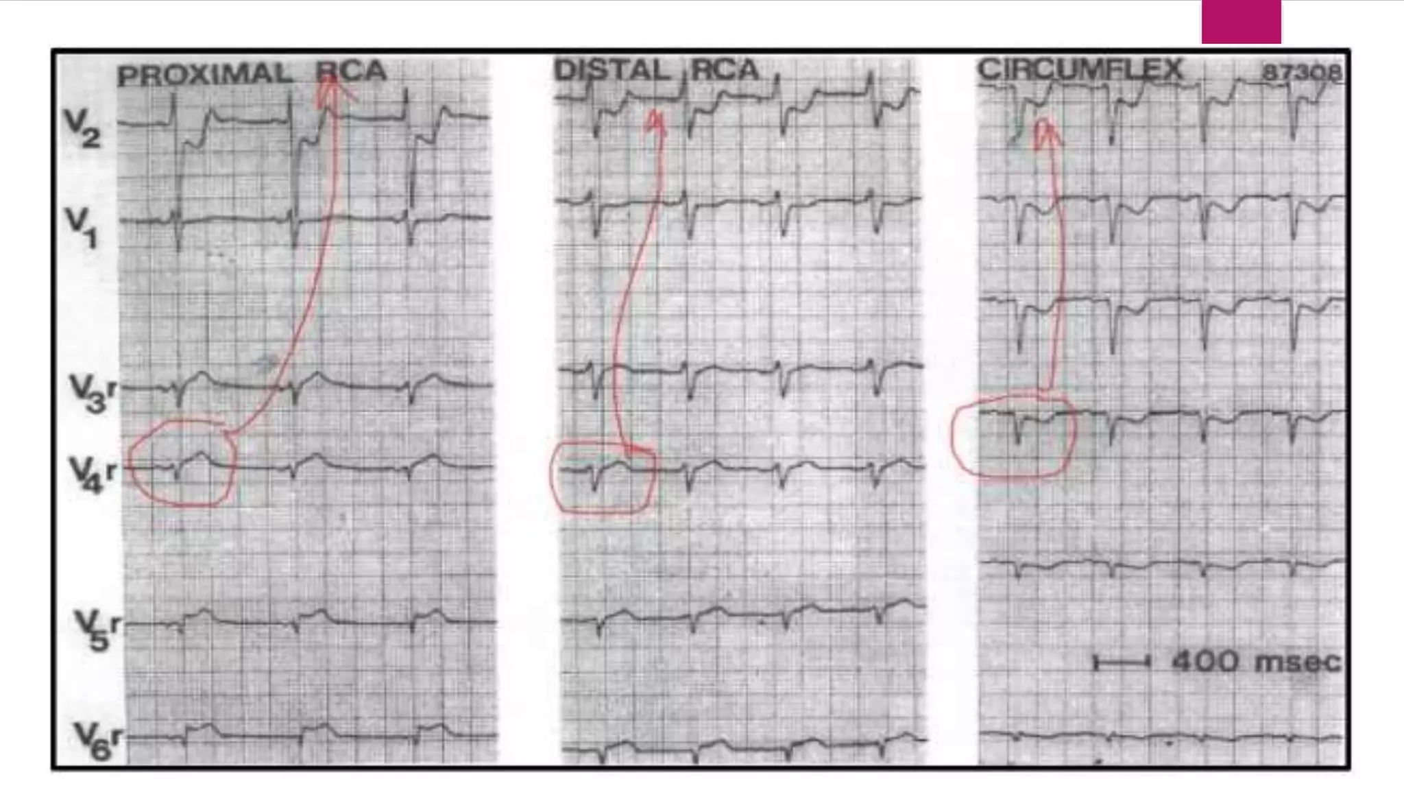 Ecg Localization Of Myocardial Infarction Pptx Heart And