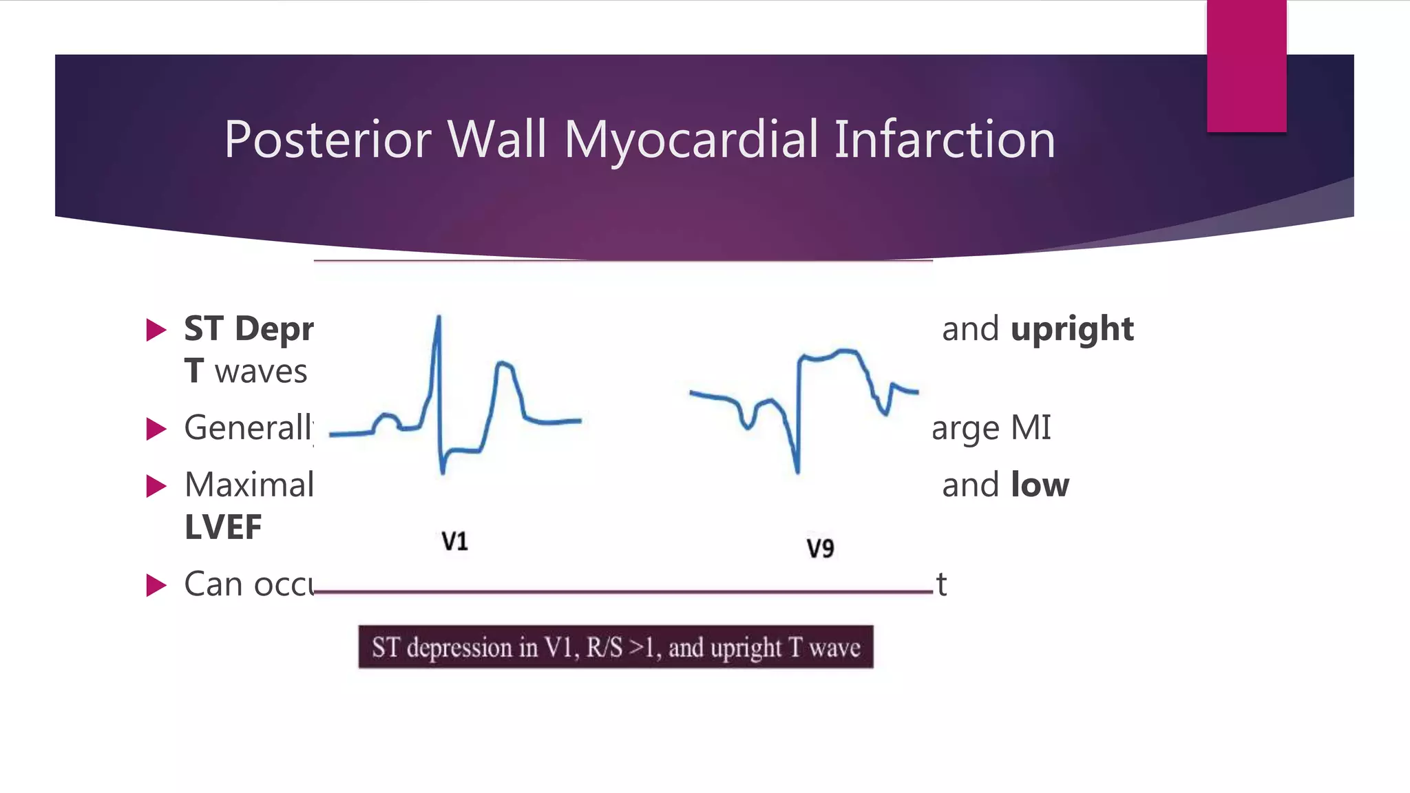 Ecg Localization Of Myocardial Infarction Pptx Heart And Cardiovascular Diseases Diseases