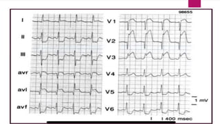 Ecg localization of myocardial infarction | PPTX