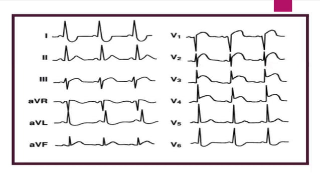 Ecg localization of myocardial infarction | PPTX | Heart and ...