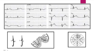 Ecg localization of myocardial infarction | PPTX