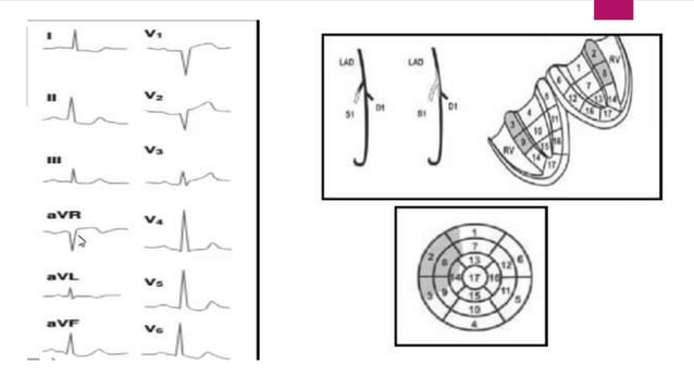 Ecg localization of myocardial infarction | PPTX | Heart and ...