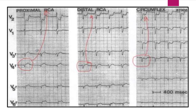 Ecg localization of myocardial infarction | PPTX | Heart and ...