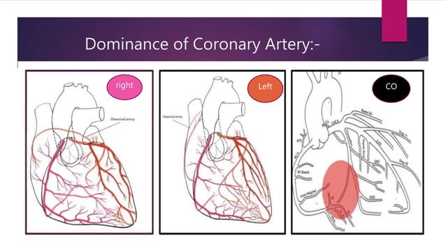 Ecg localization of myocardial infarction | PPTX | Heart and ...