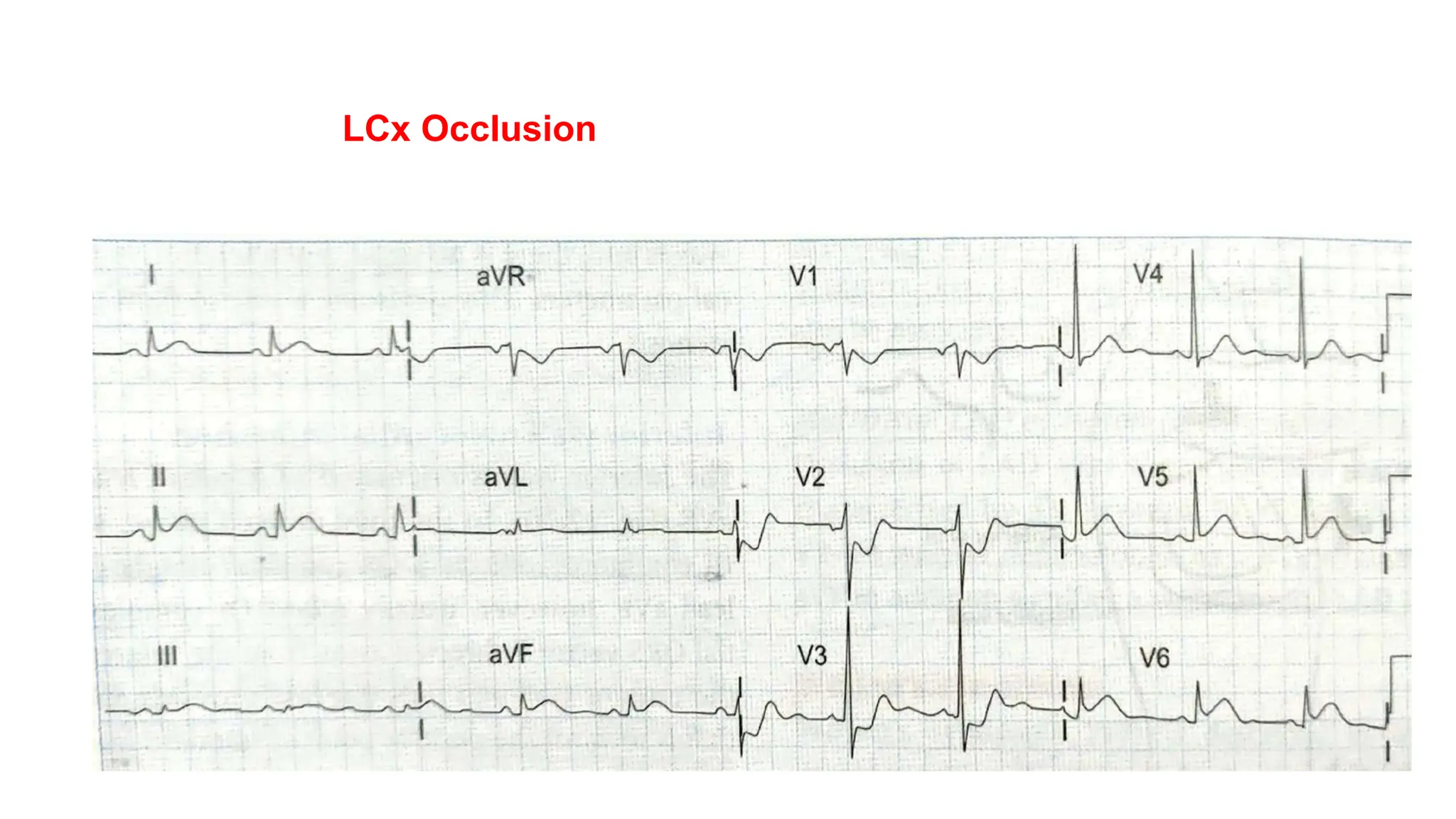 ECG LOCALIZTION OF CULPRIT VESSEL IN MI.pptx