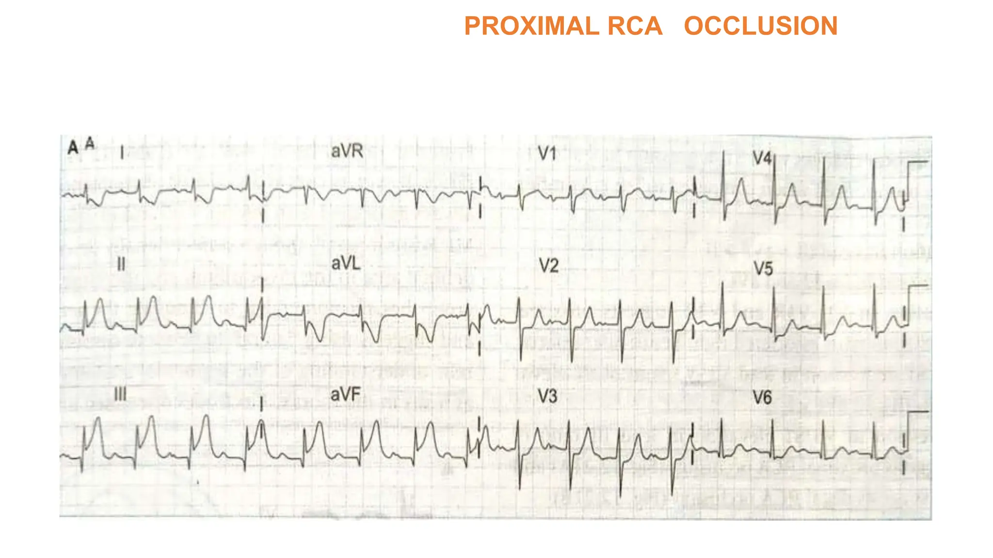 ECG LOCALIZTION OF CULPRIT VESSEL IN MI.pptx