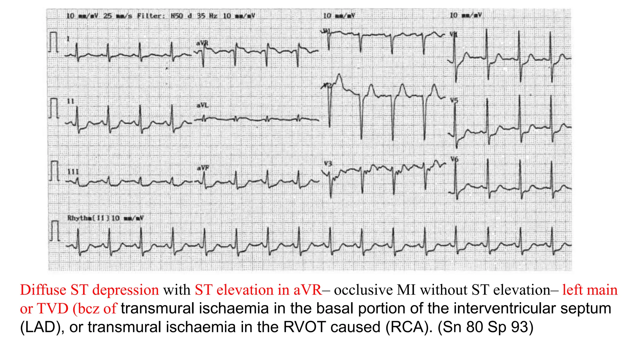 ECG LOCALIZTION OF CULPRIT VESSEL IN MI.pptx