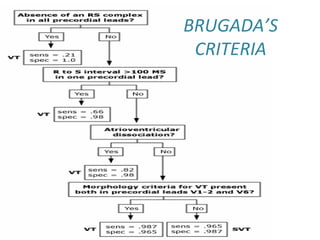 ECG: Wide Complex Tachycardia | PPT