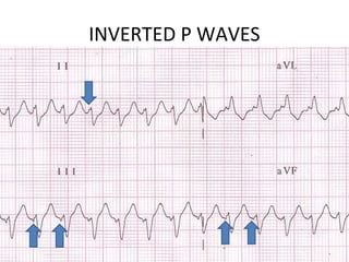 ECG: Wide Complex Tachycardia | PPT