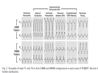 ECG: Wide Complex Tachycardia | PPT