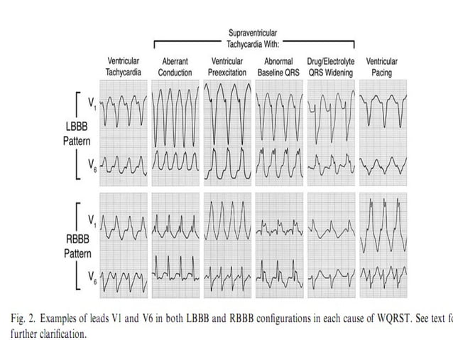 ECG: Wide Complex Tachycardia | PPT