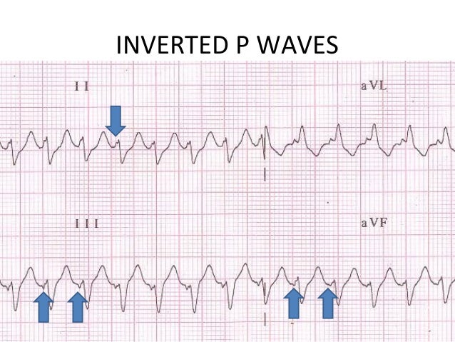 ECG: Wide Complex Tachycardia