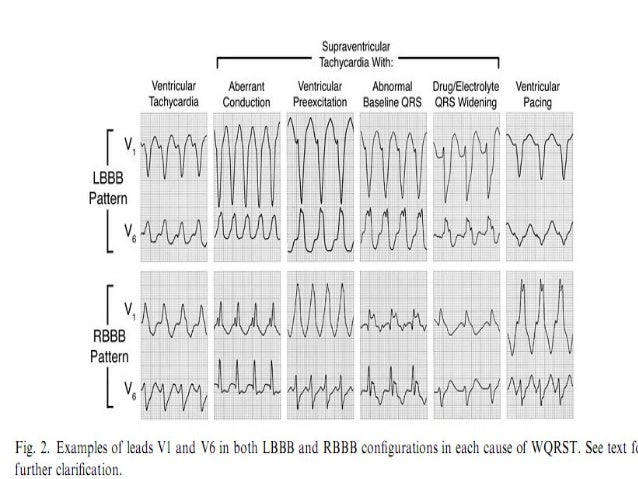 ECG: Wide Complex Tachycardia