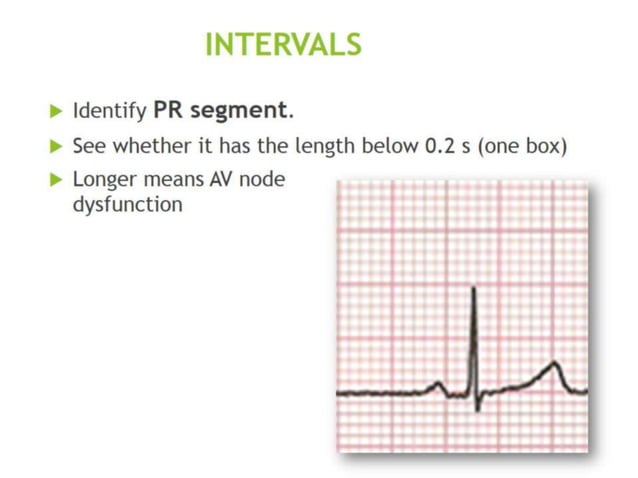 ECG-Get to know the Simplest Understanding of ECG | PPTX