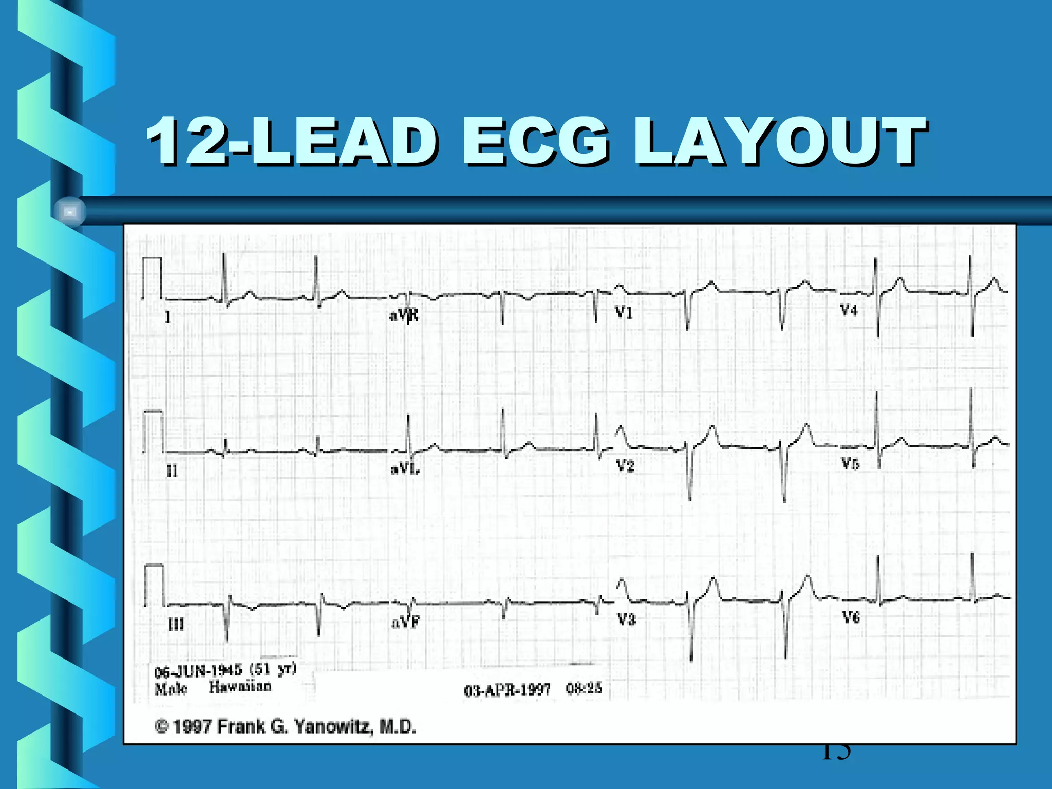 Ecg made easy | PPT