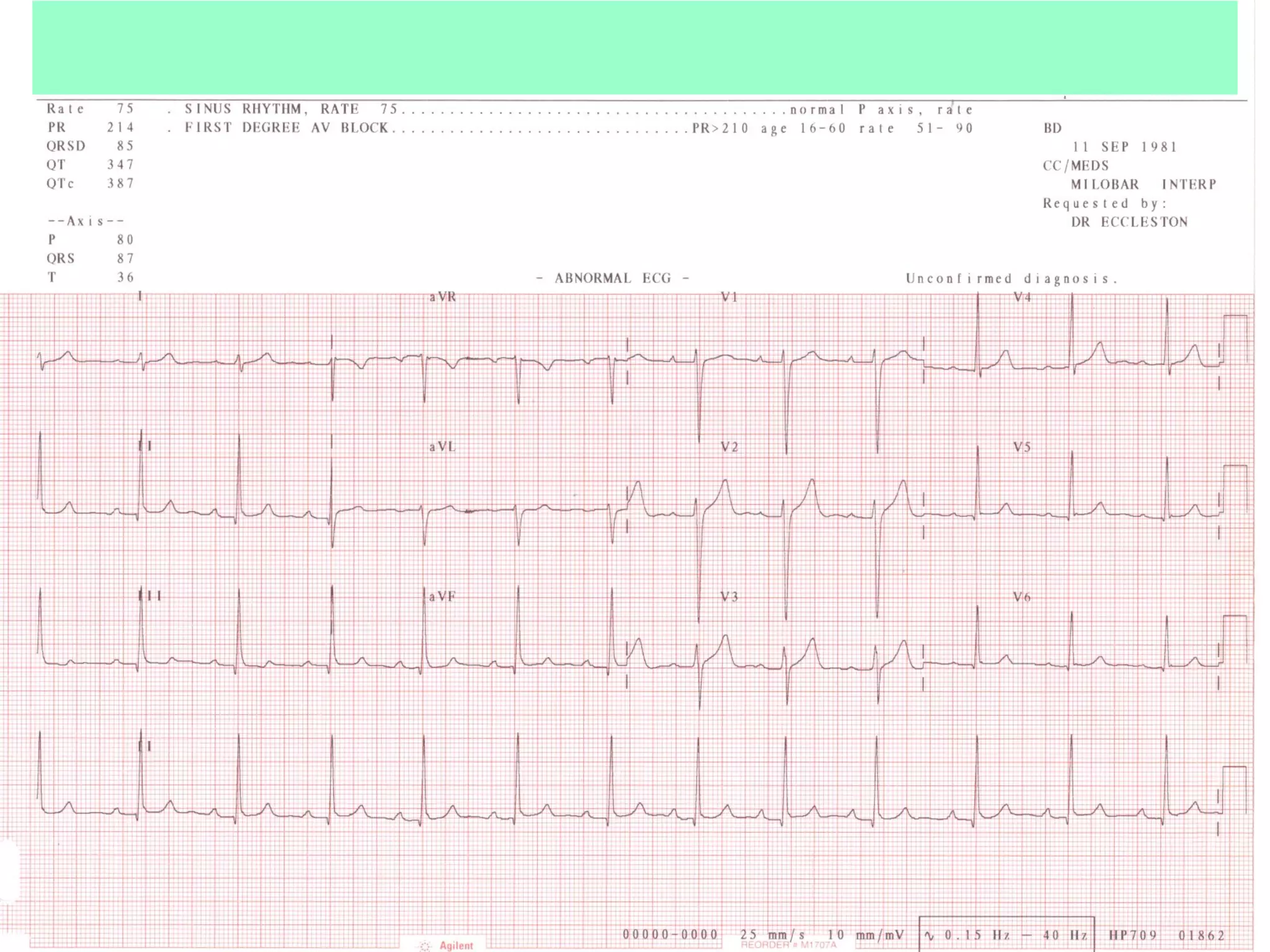 Ecg made easy | PPT
