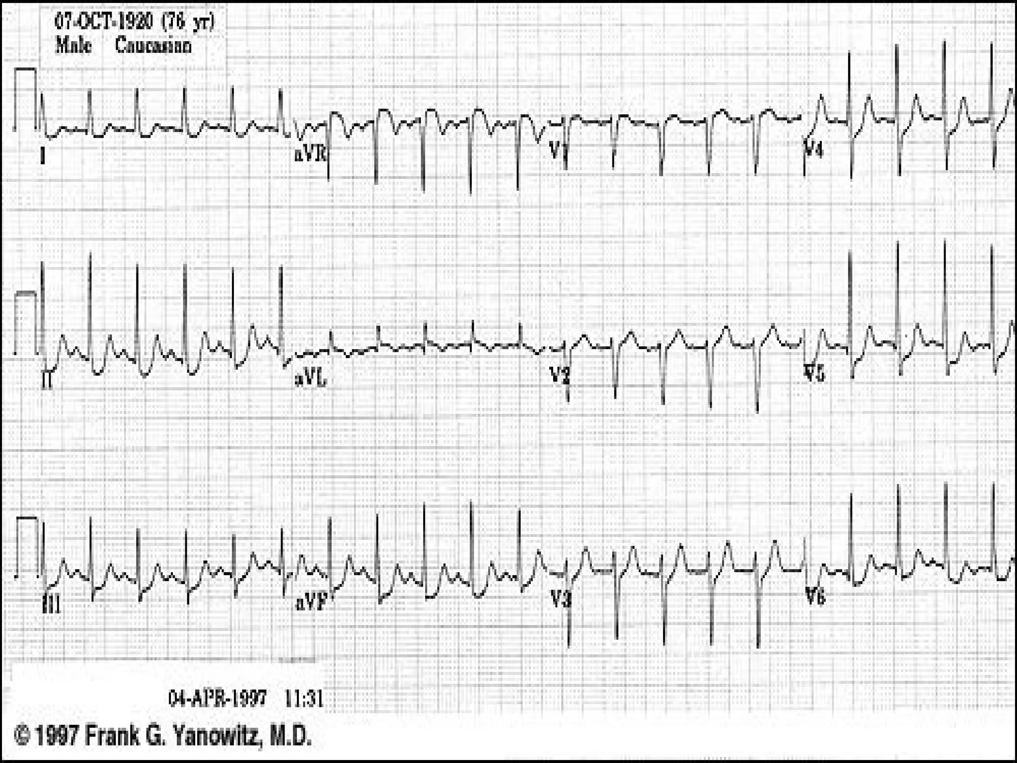 Ecg made easy | PPT