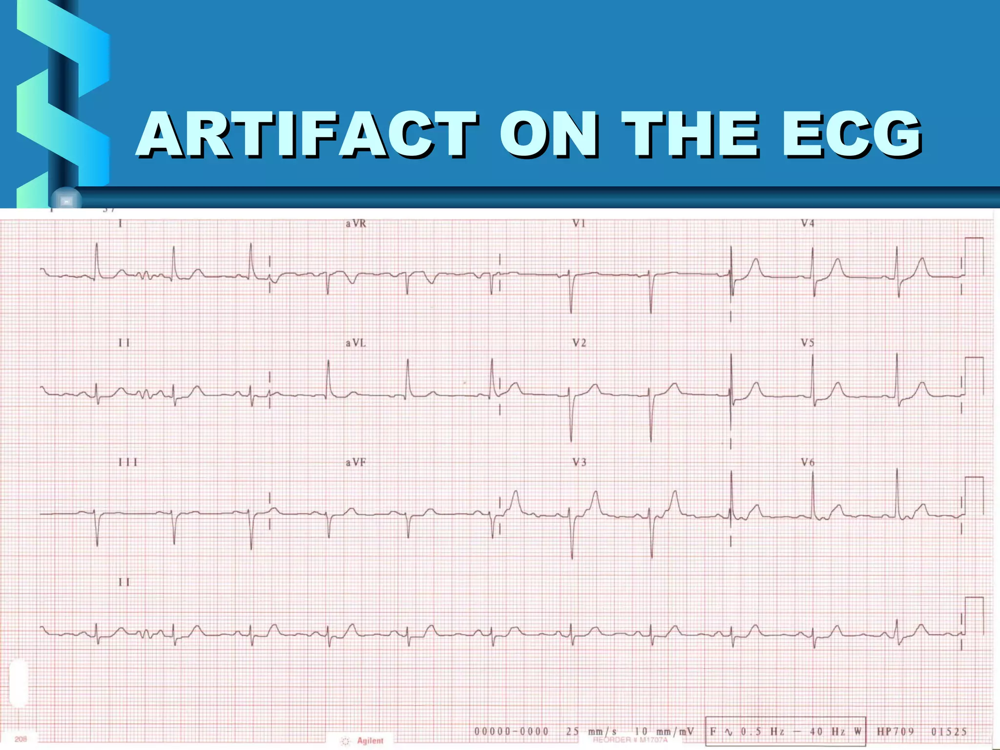 Ecg made easy | PPT