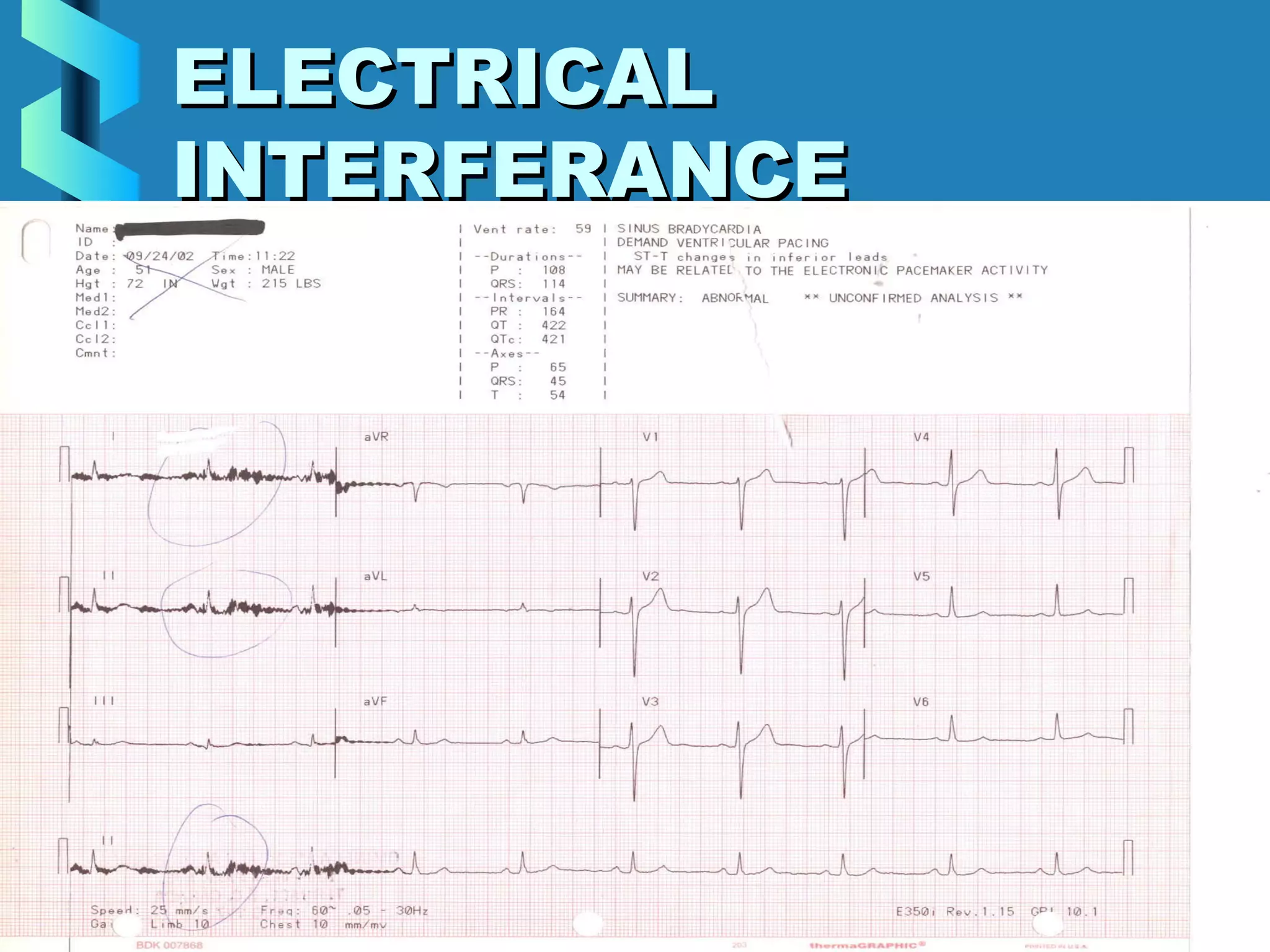 Ecg made easy | PPT