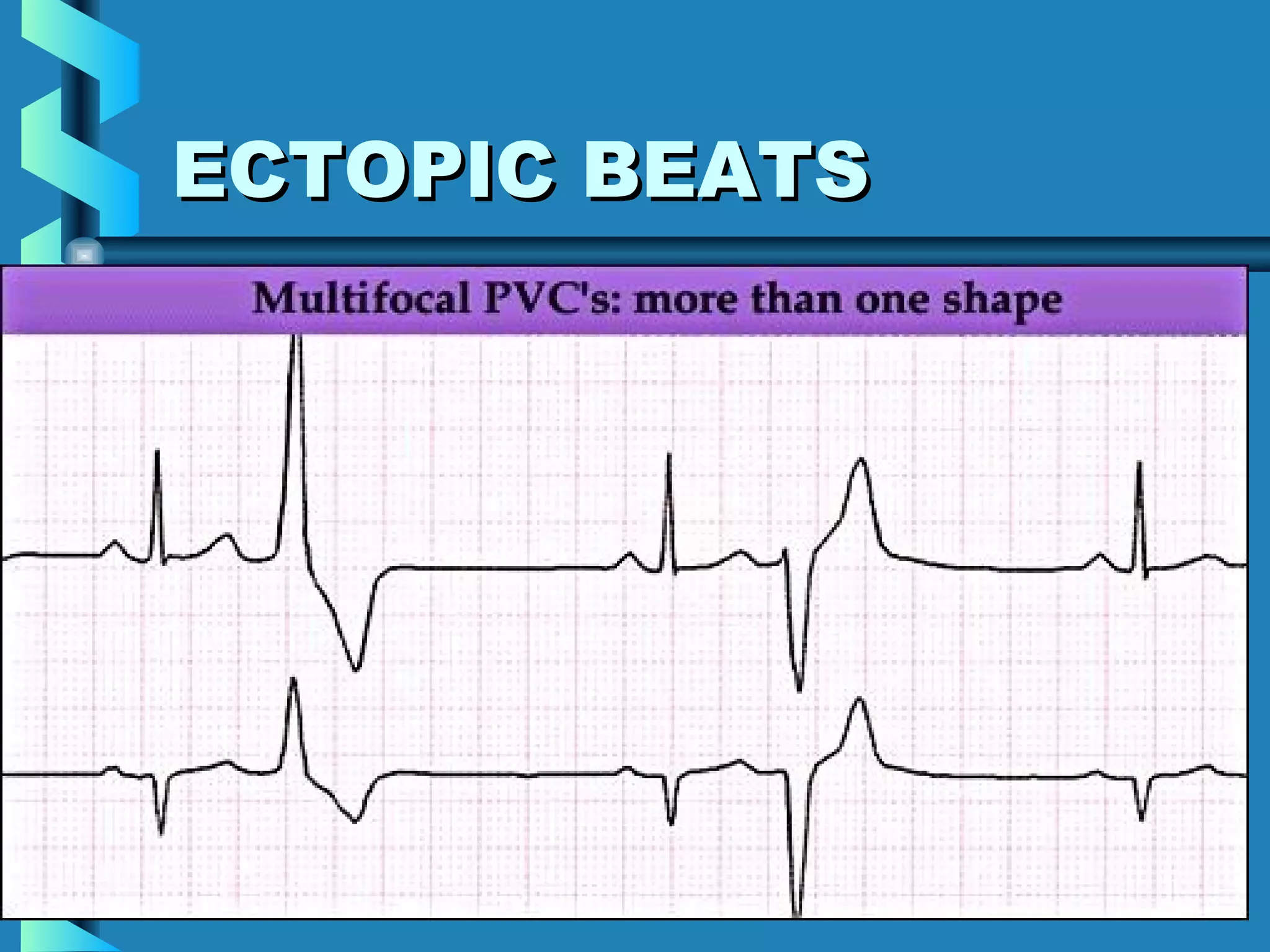 Ecg made easy | PPT