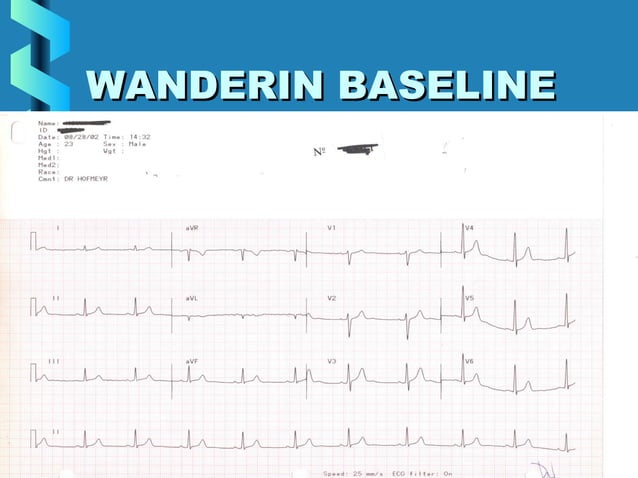 Ecg made easy | PPT