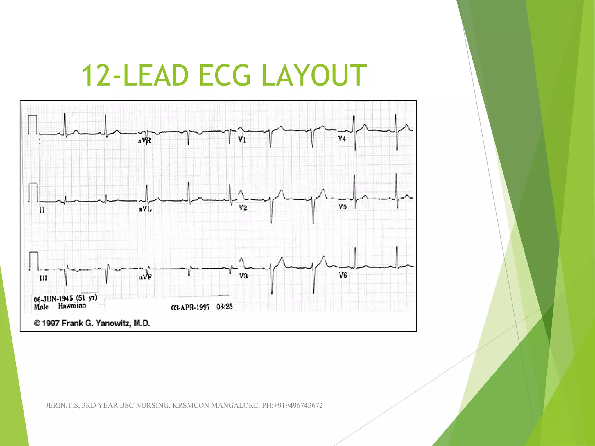 Ecg made easy ppt | PPT