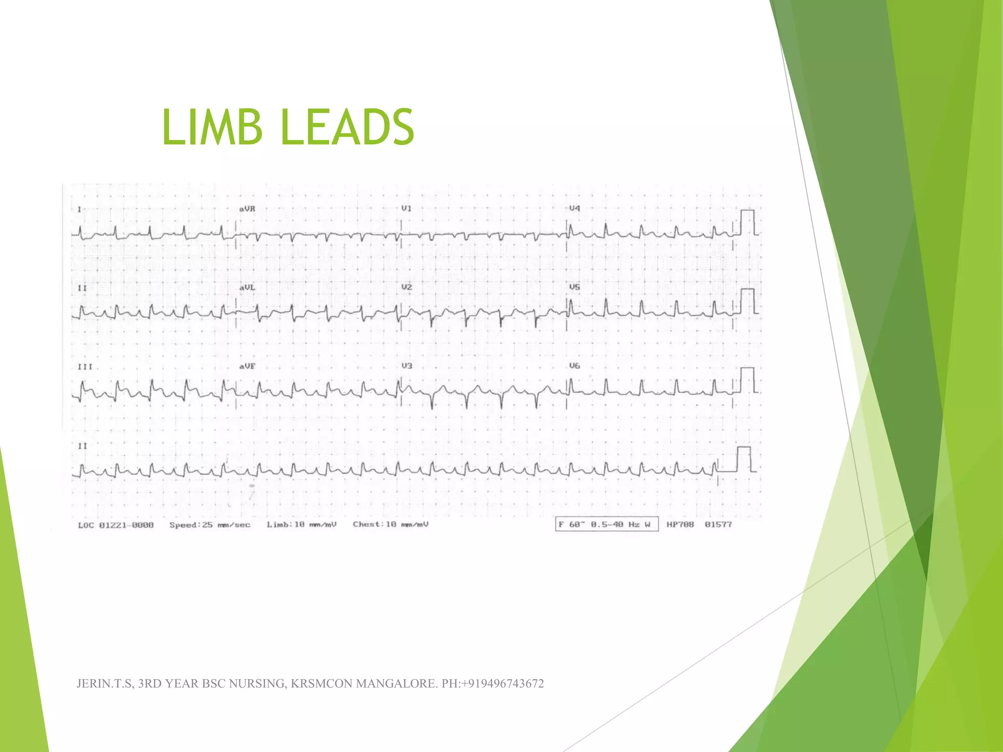 Ecg made easy ppt | PPT