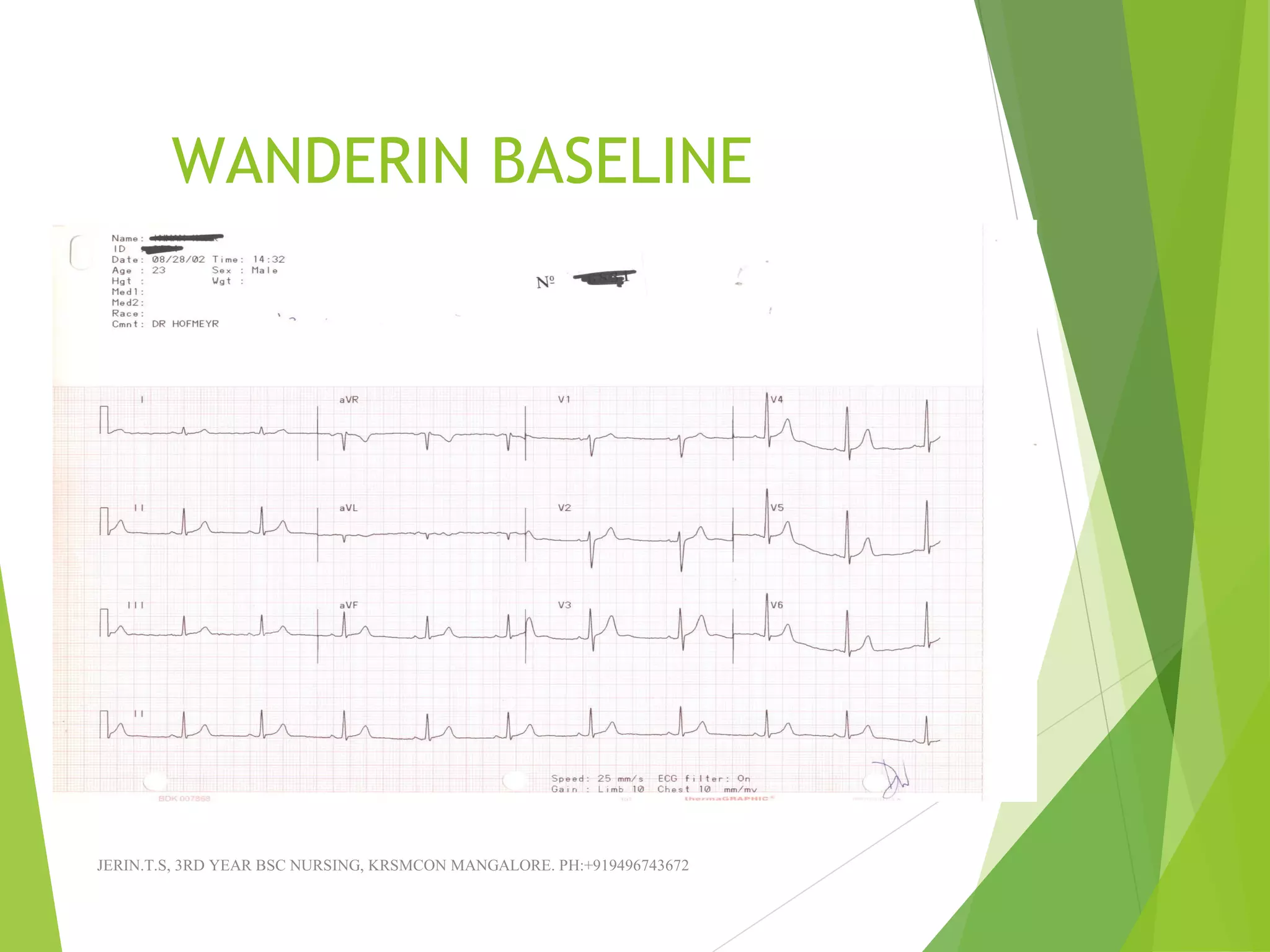 Ecg made easy ppt | PPT