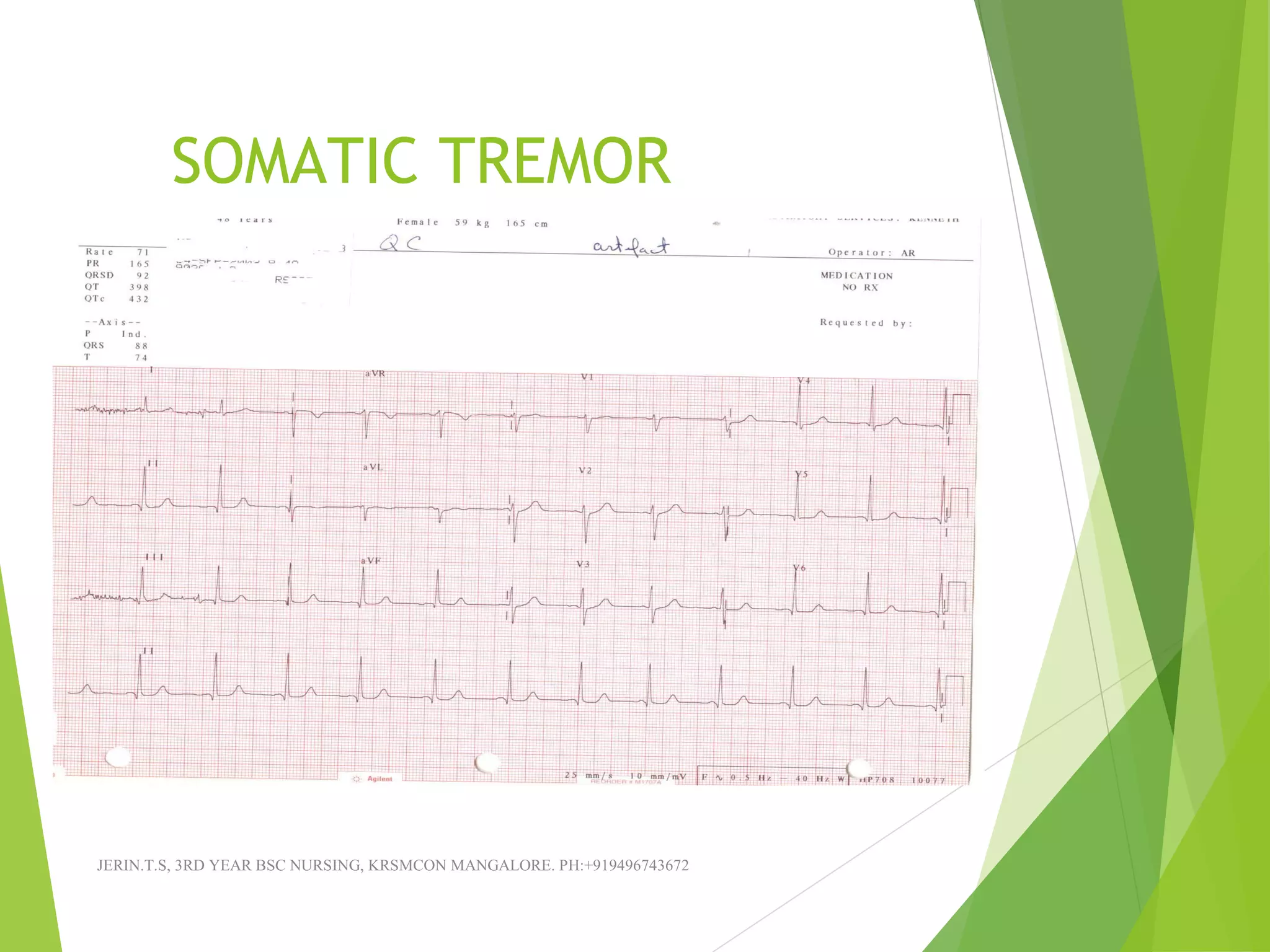 Ecg made easy ppt | PPT