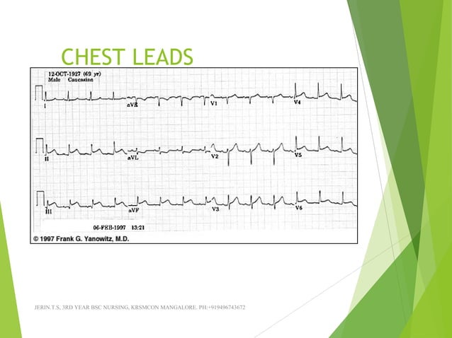 Ecg made easy ppt | PPT