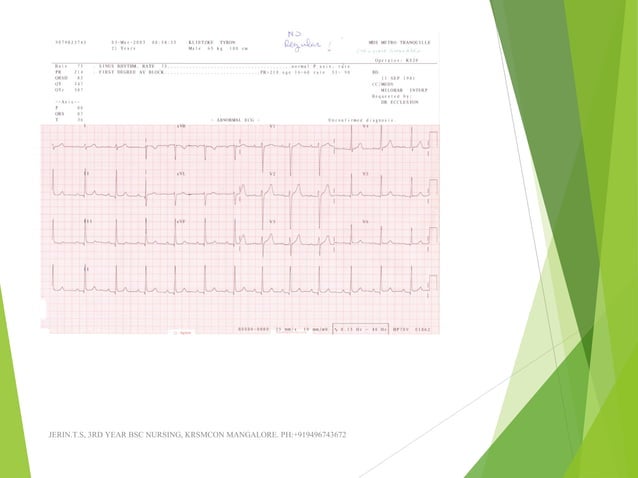 Ecg made easy ppt | PPT