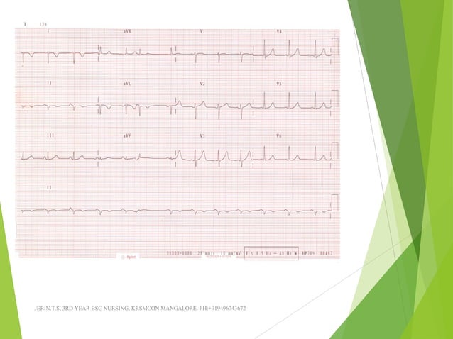 Ecg made easy ppt | PPT