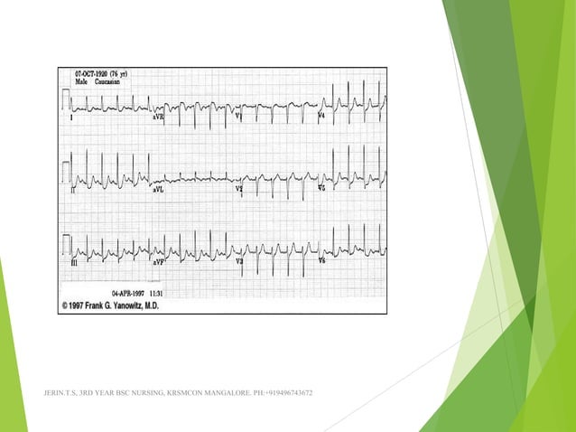 Ecg made easy ppt | PPT