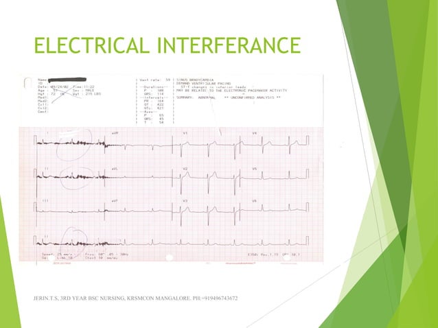 Ecg made easy ppt | PPT
