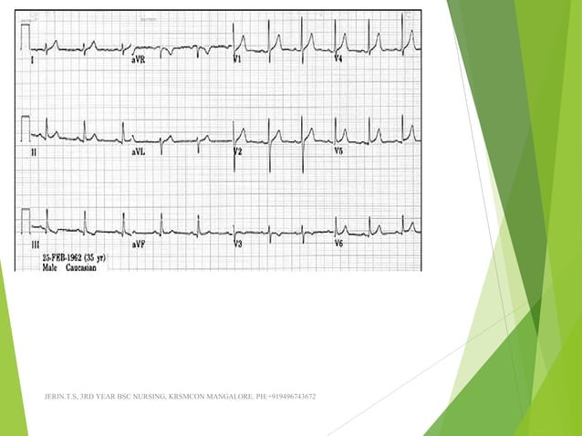 Ecg made easy ppt | PPT