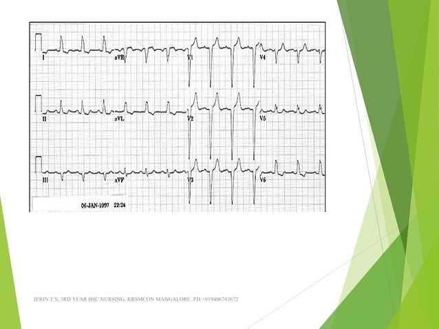 Ecg made easy ppt | PPT