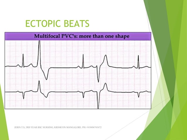 Ecg made easy ppt | PPT