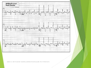 Junctional Bradycardia Rhythm Strip
