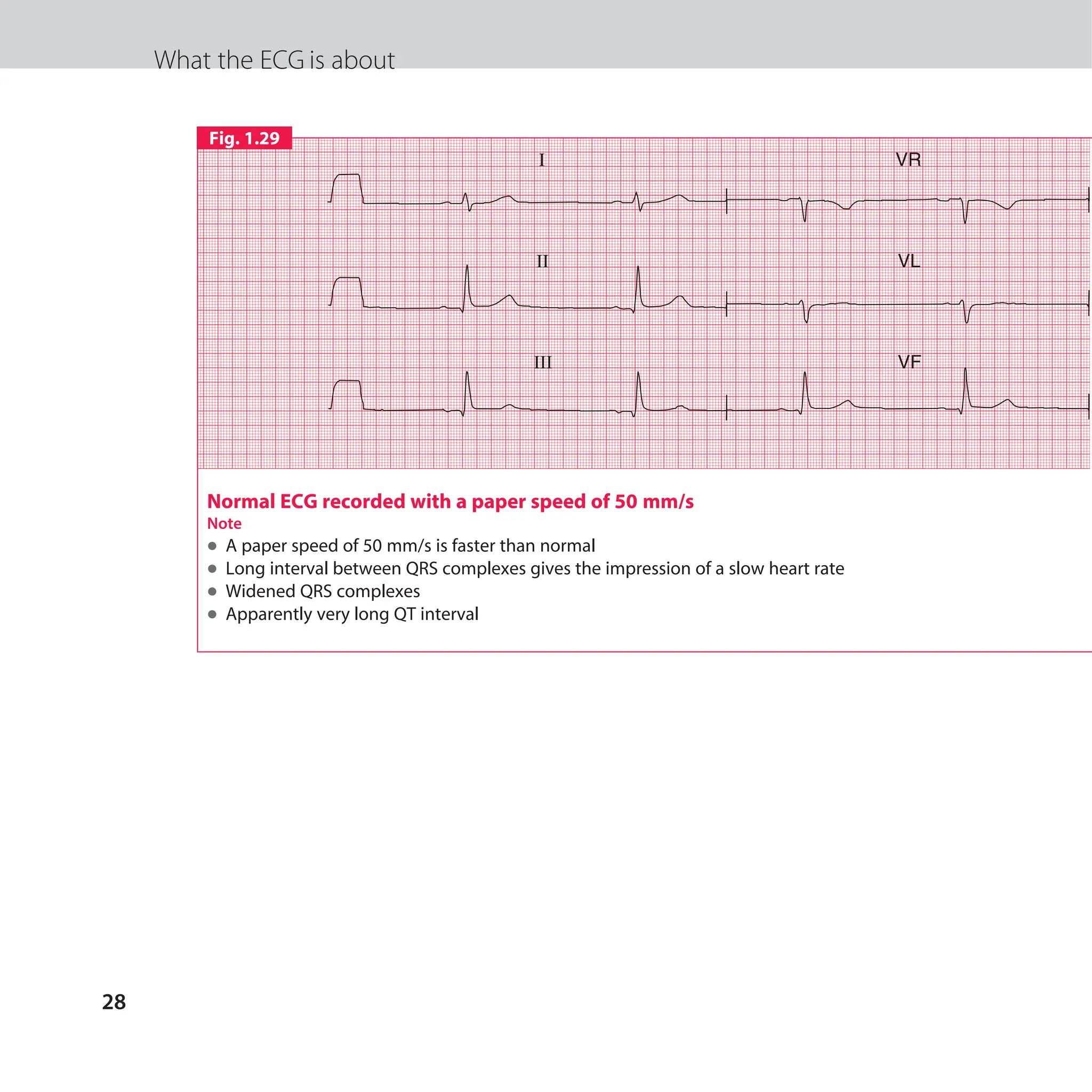 The ECG made easy guide. Guide on how to read ECG's quick and ...