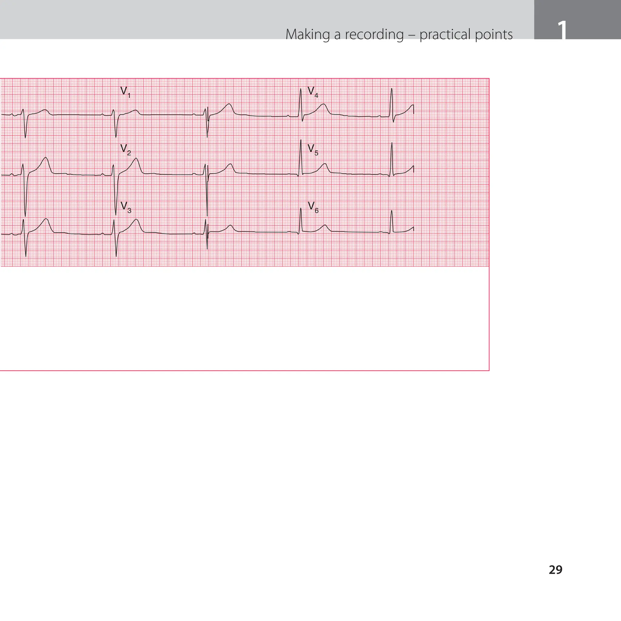 The ECG made easy guide. Guide on how to read ECG's quick and ...