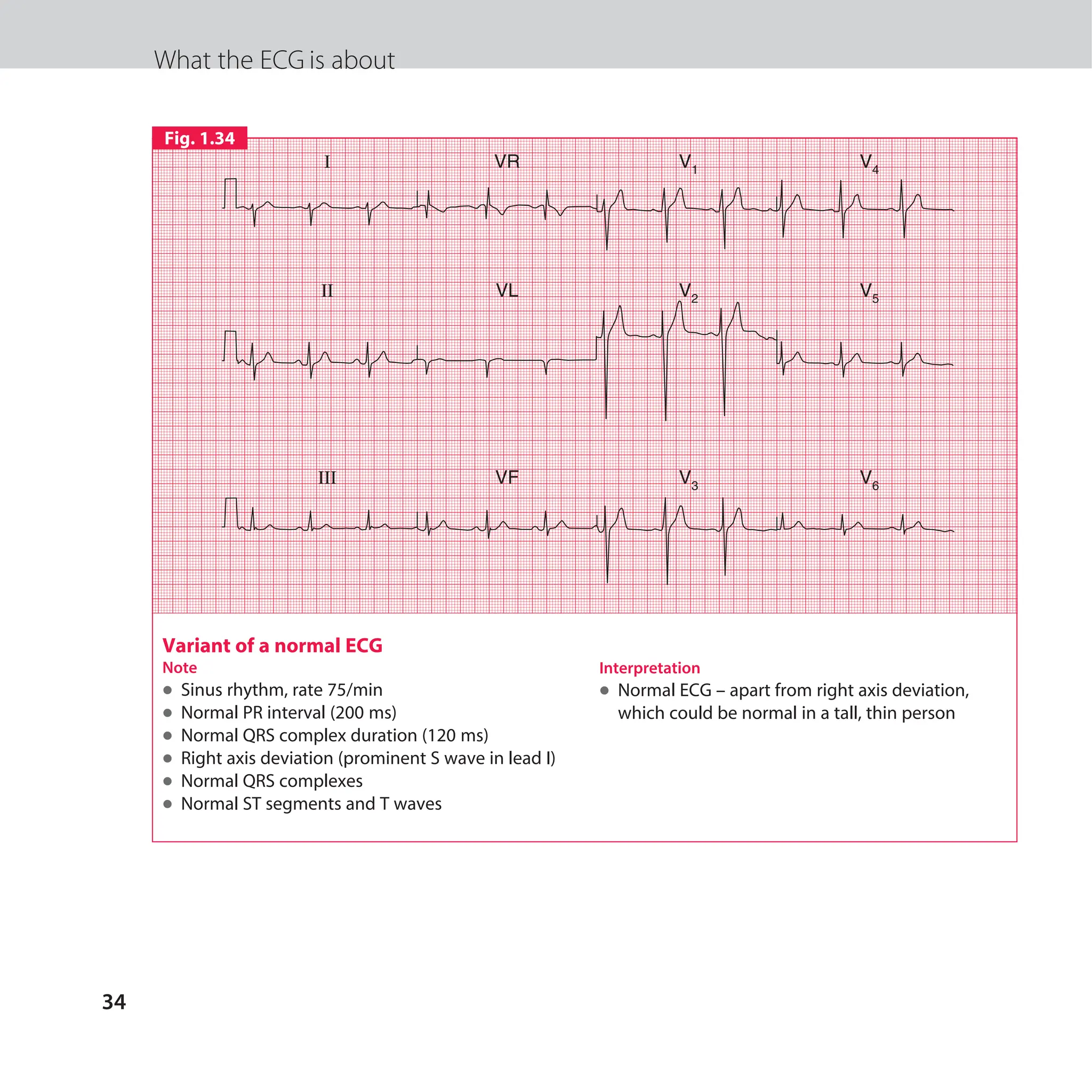 The ECG made easy guide. Guide on how to read ECG's quick and ...