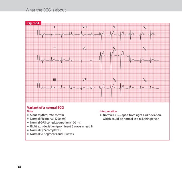 The ECG made easy guide. Guide on how to read ECG's quick and ...