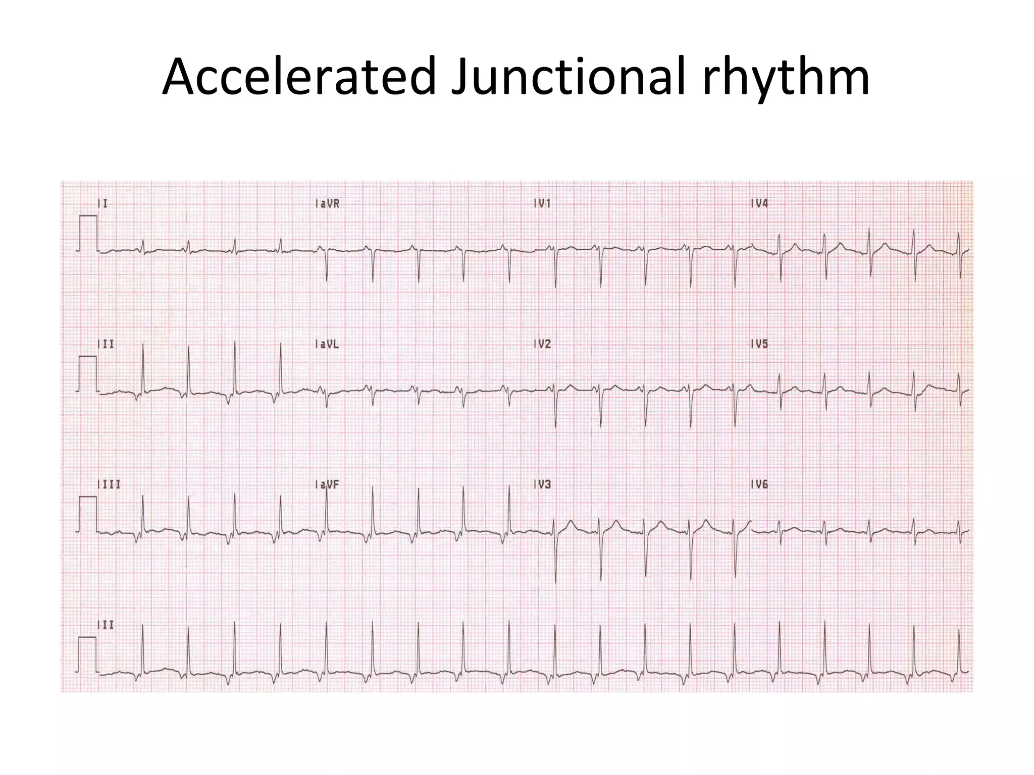 ECG manifestations of drug overdose | PPT