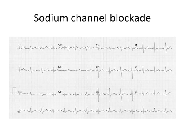 ECG manifestations of drug overdose | PPT