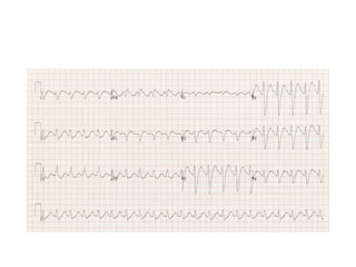 ECG manifestations of drug overdose | PPT
