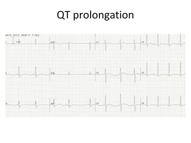 ECG manifestations of drug overdose | PPT