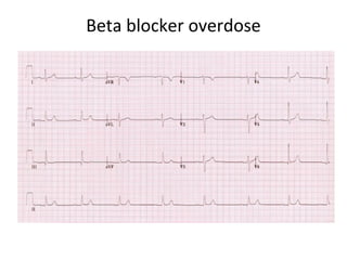ECG manifestations of drug overdose | PPT