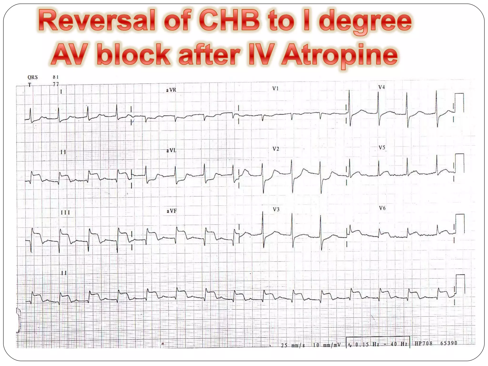 ECG: Myocardial Infarction with CHB | PPT