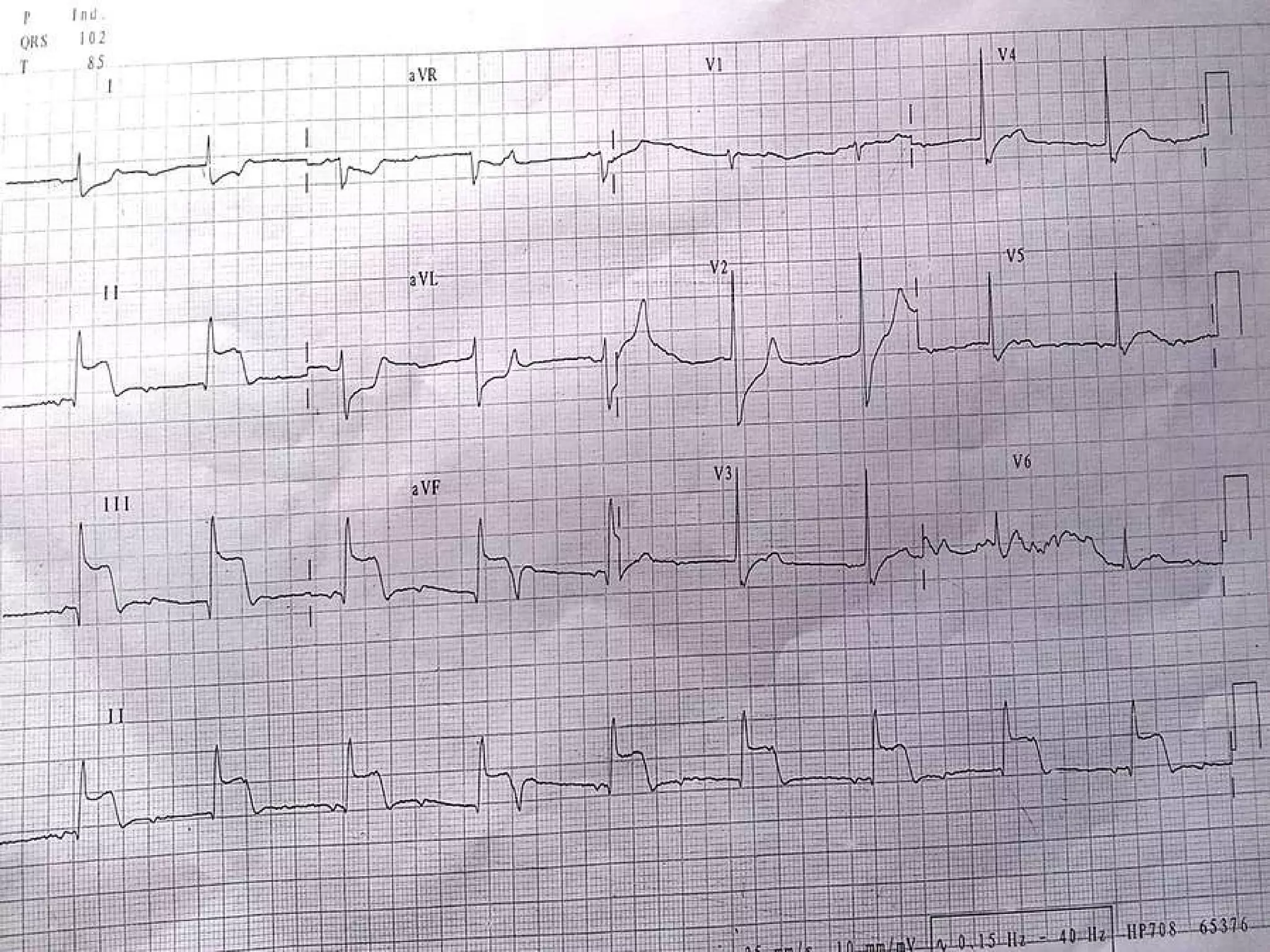 ECG: Myocardial Infarction with CHB | PPT