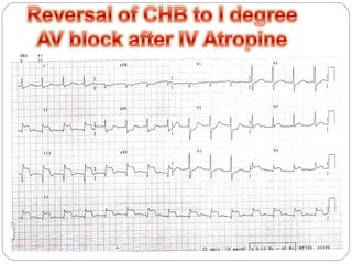 ECG: Myocardial Infarction with CHB | PPT